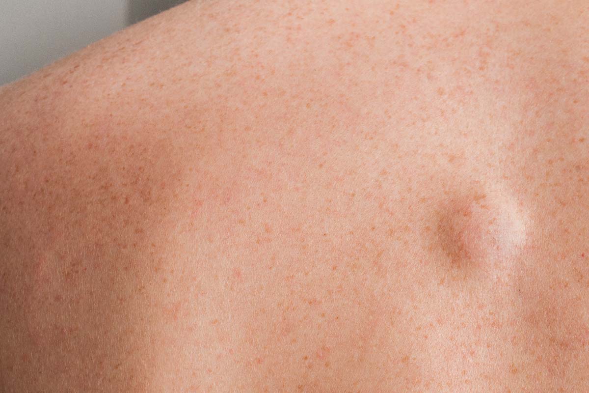 Raised Skin Bumps: Causes, Symptoms, and Treatments - CLNQ Manchester ...