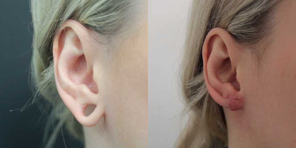 Stretched Earlobe Repair Manchester & Cheshire | CLNQ Clinic
