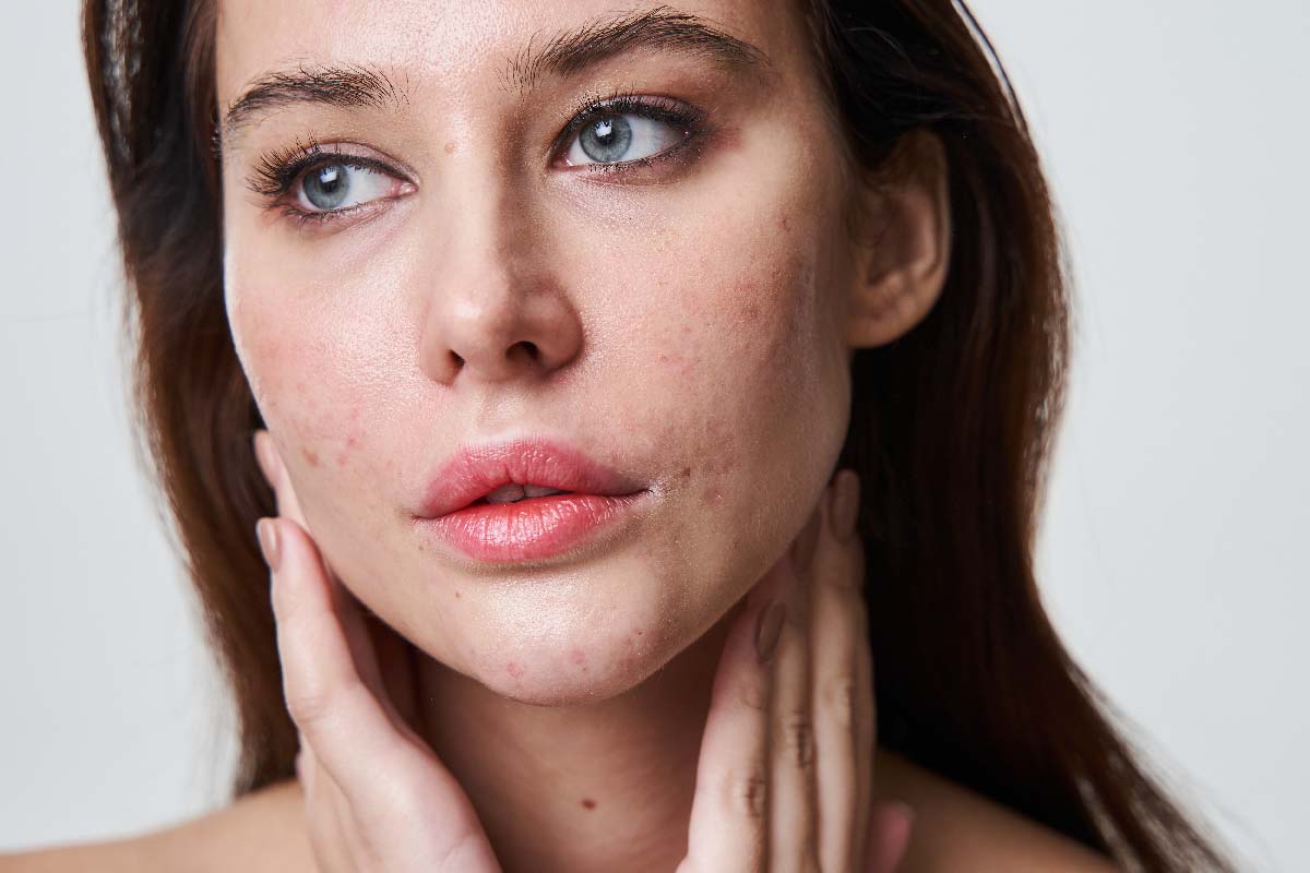 Acne Punch Excision - CLNQ Manchester | Cheshire | Medical Surgical ...